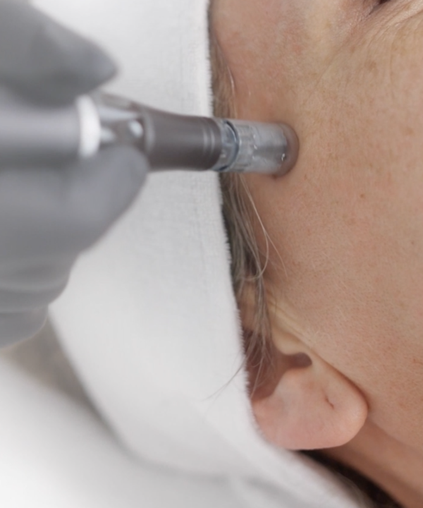 Micro Needling PRO • Beaunited